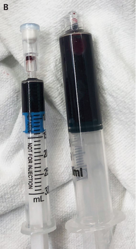 สาวช็อก ตัวซีดเป็นศพ เลือดเป็นสีน้ำเงิน หลังใช้ยาชาแปรงฟัน