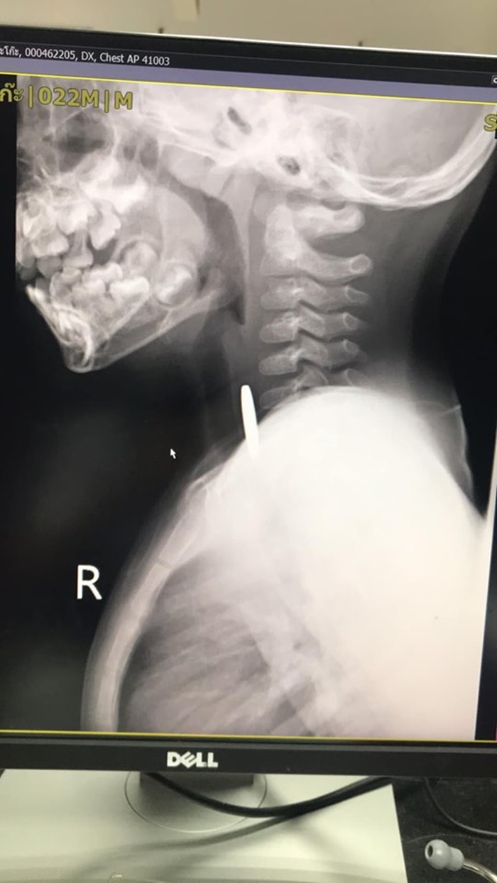 หมอเผยเคส เด็กกลืนเหรียญ ญาติไม่ให้ผ่าตัด จะพาไปหาหมอบ้านเป่าคาถาสลาย