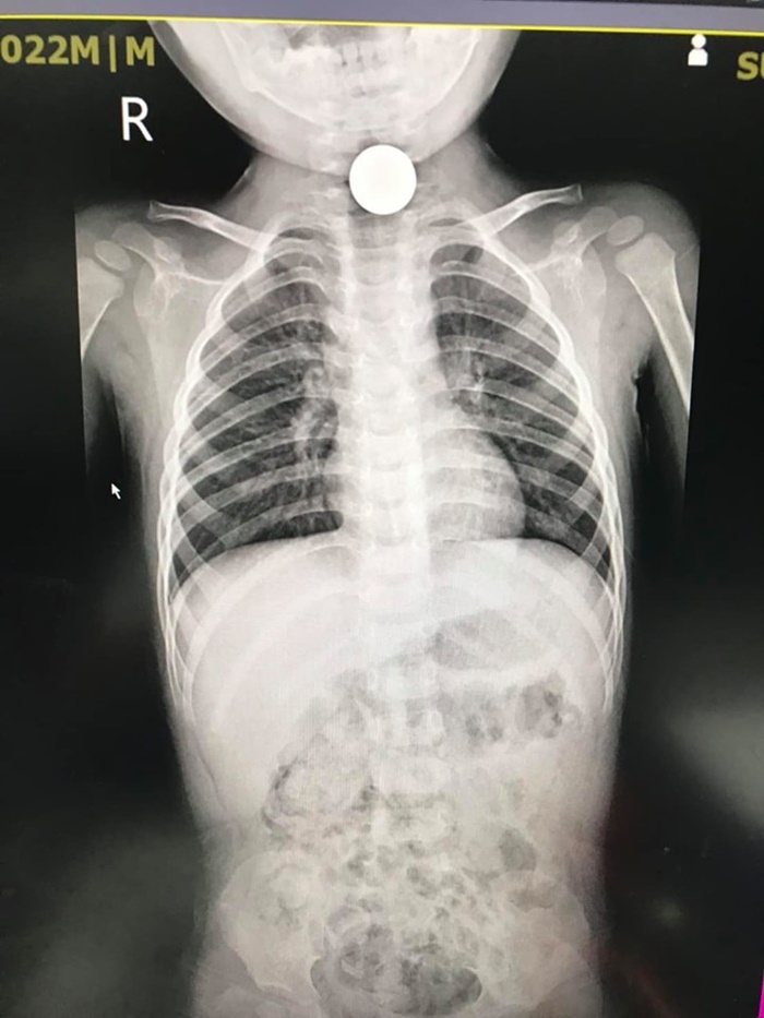 หมอเผยเคส เด็กกลืนเหรียญ ญาติไม่ให้ผ่าตัด จะพาไปหาหมอบ้านเป่าคาถาสลาย