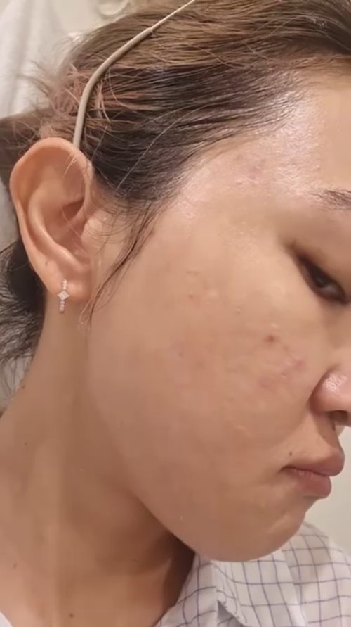 อุทาหรณ์ กดสิว เลเซอร์ นึกว่าหน้าจะใส ได้หน้าไหม้แทน ร้องแล้วไม่คืบ ...