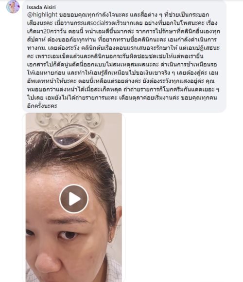 อุทาหรณ์ กดสิว เลเซอร์ นึกว่าหน้าจะใส ได้หน้าไหม้แทน ร้องแล้วไม่คืบ ...