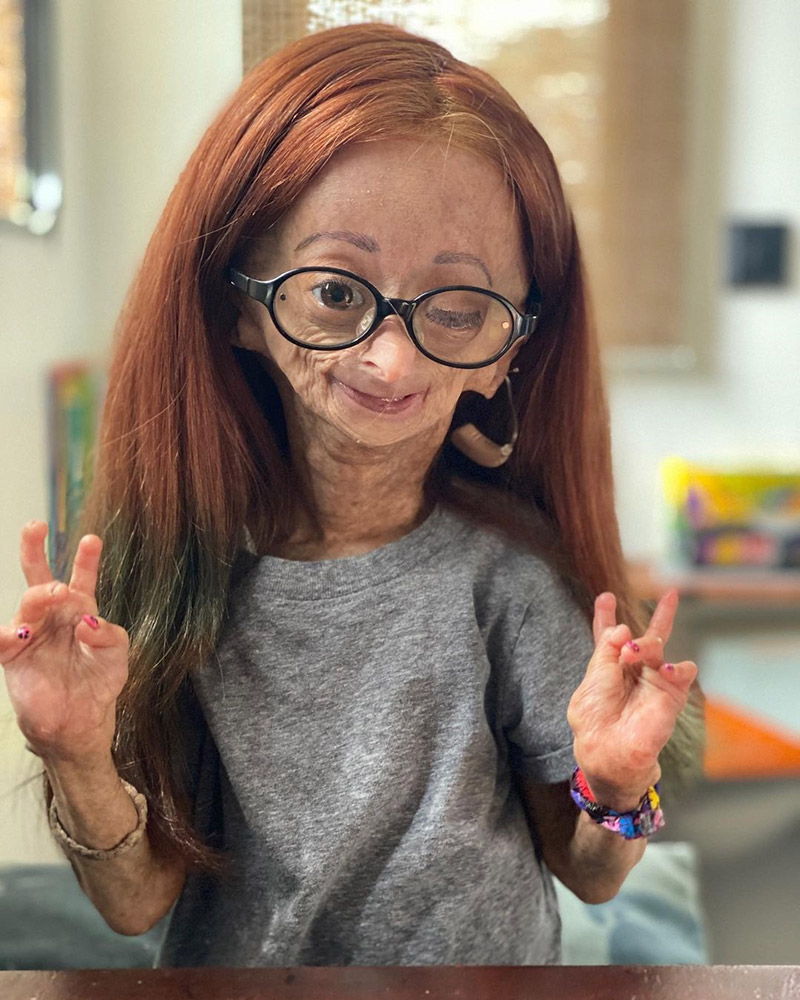 Adalia Rose ยูทูบเบอร์สาวป่วยแปลก โรคโพรจีเรีย แก่ตั้งแต่เด็ก เสียชีวิต ...